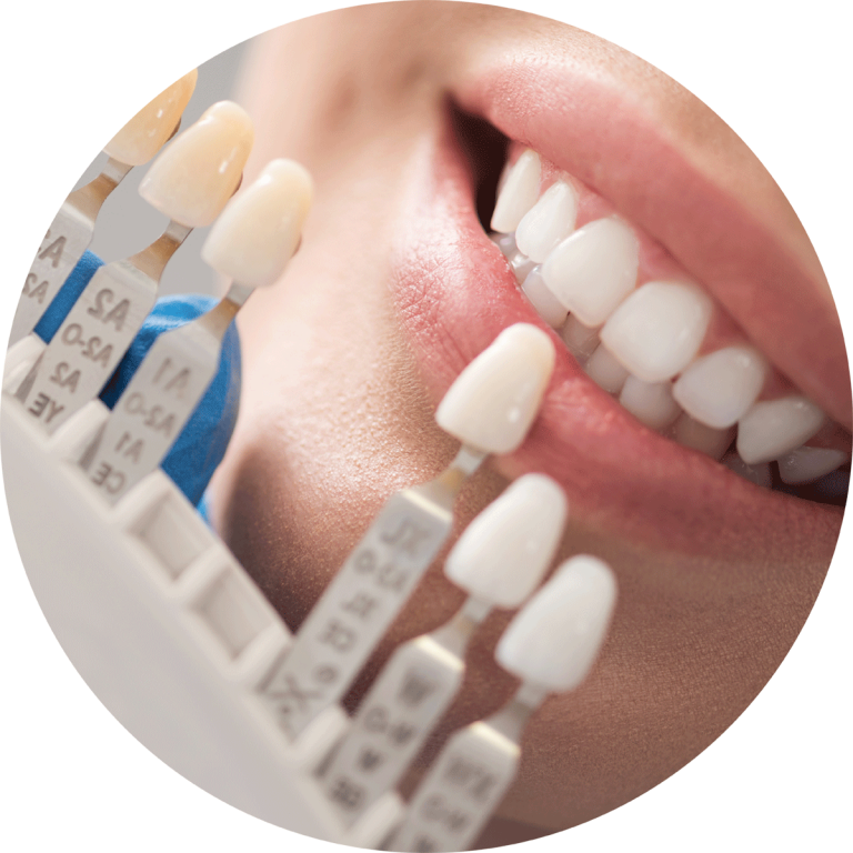 Veneers - Toothpaste Family Dentistry